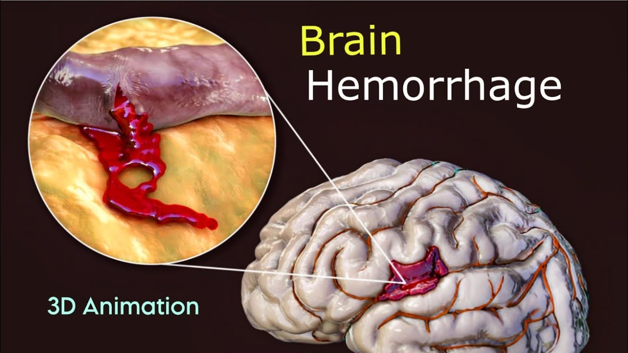 What Triggers Brain Hemorrhage? : 3D Animation | Scopic Vision - YouTube