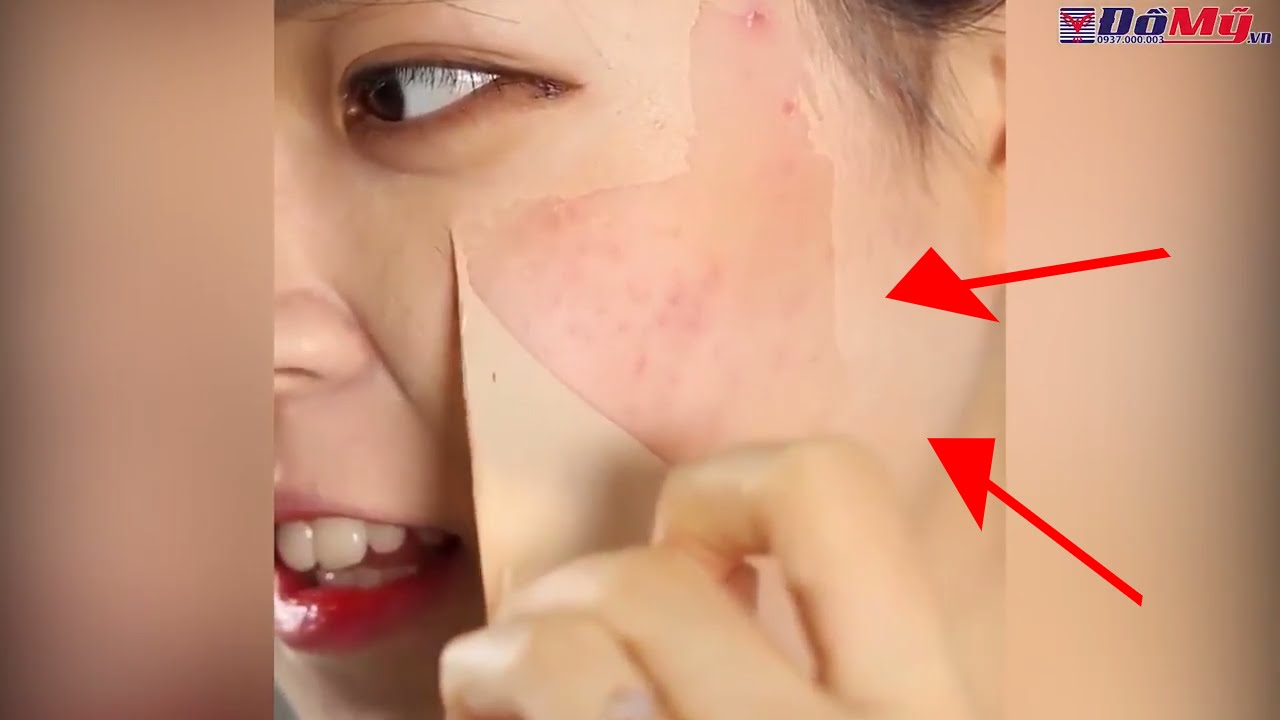 Gel Vá Da Che Mụn Khuyến Điểm - NOT4U REAL SKIN PATCH - Đồ Mỹ .vn - domy.vn - YouTube