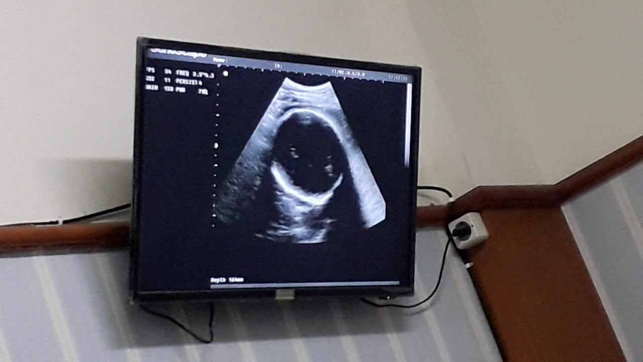 USG 2D 9 bulan - YouTube