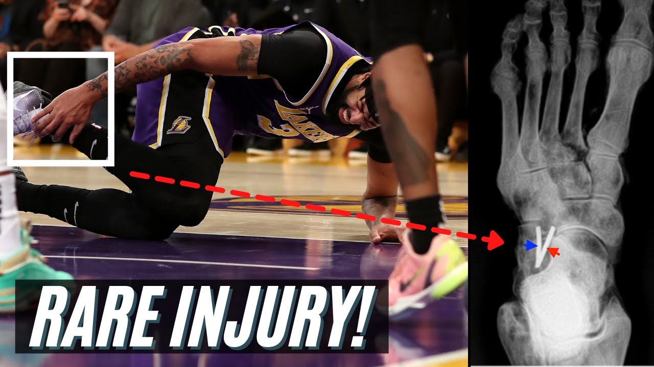 Expert Explains Anthony Davis Injury & Timeline | Rare Midfoot Sprain ...