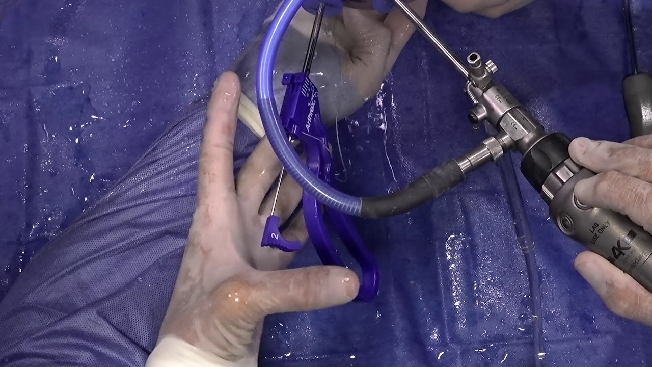 Reparación meniscal todo dentro con Meniscal Cinch - YouTube