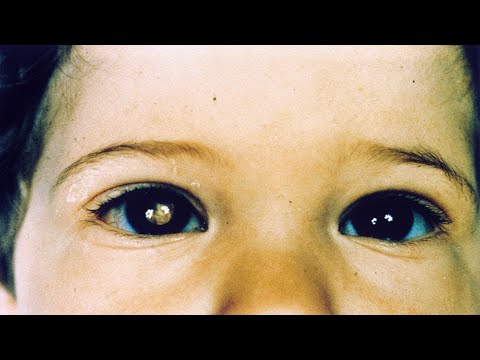 Anne, Bebeğinin Resmini İnternete Yükleyince Bir Arkadaşı Gözlerinde Korkunç Bir Şey Fark Etti