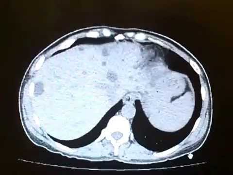 POLYCYSTIC KIDNEY DISEASE CT SCAN - YouTube