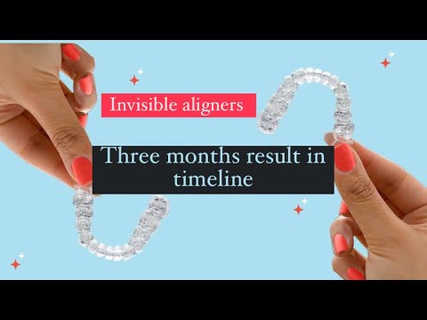 Results of invisible aligners by Tootshi - 3 months in timeline - YouTube