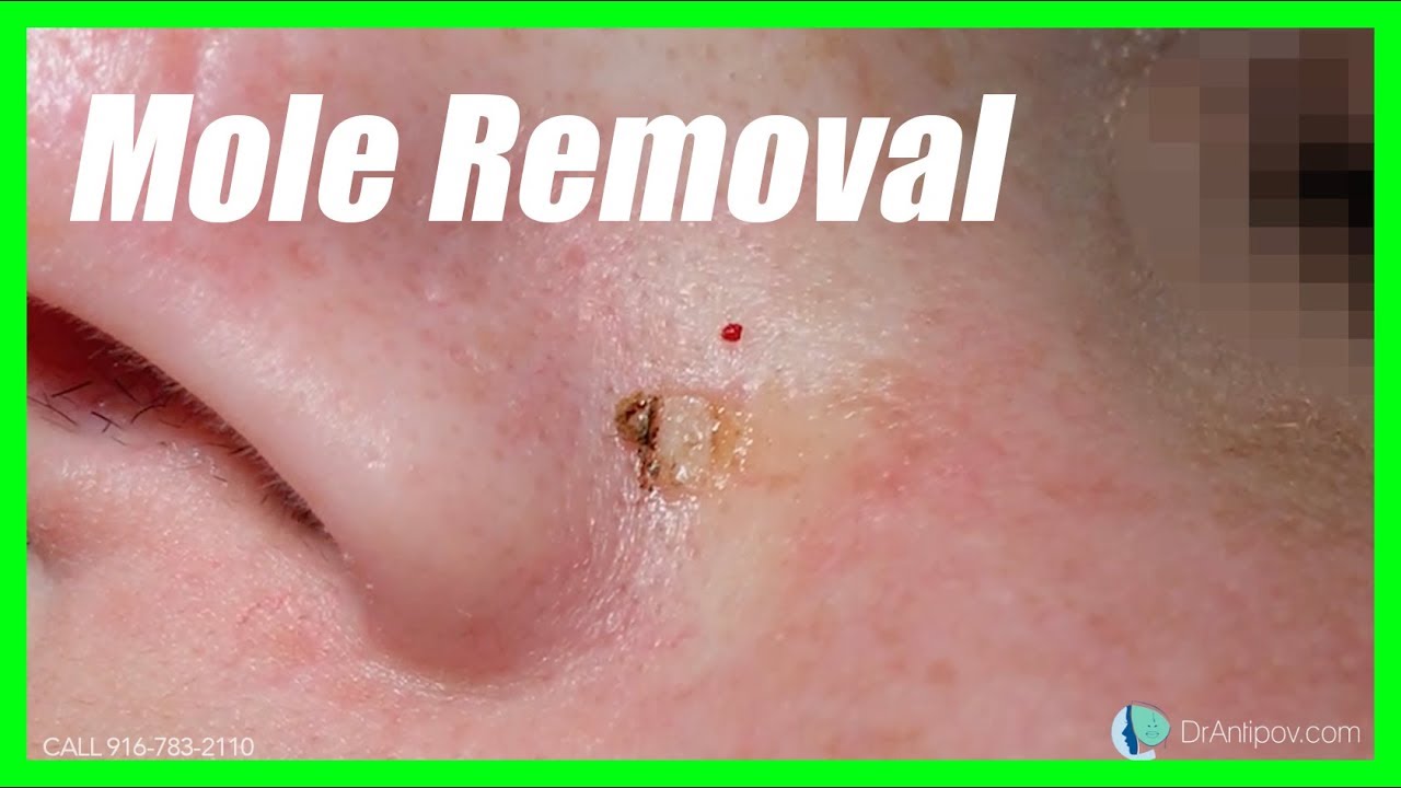 Mole Removal - YouTube
