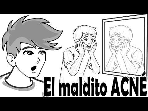 LA MALDITA DESGRACIA DE SUFRIR ACNÉ