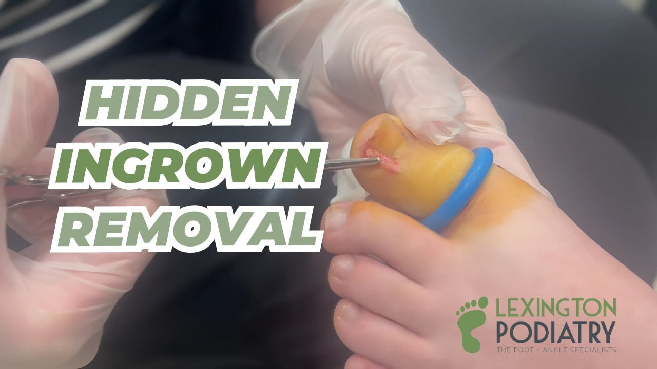 HIDDEN Ingrown Toenail Removal - YouTube