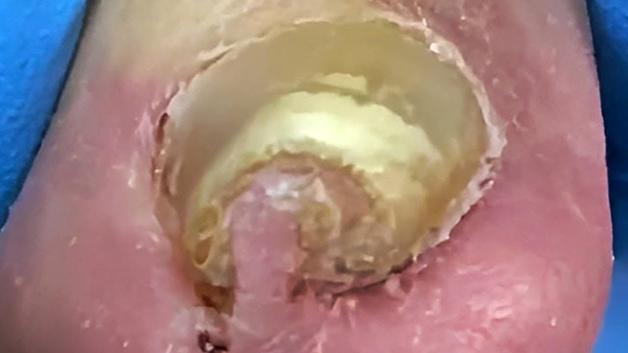 Rare Super Curly Nails! Dig Out The Big Hook Inside - YouTube