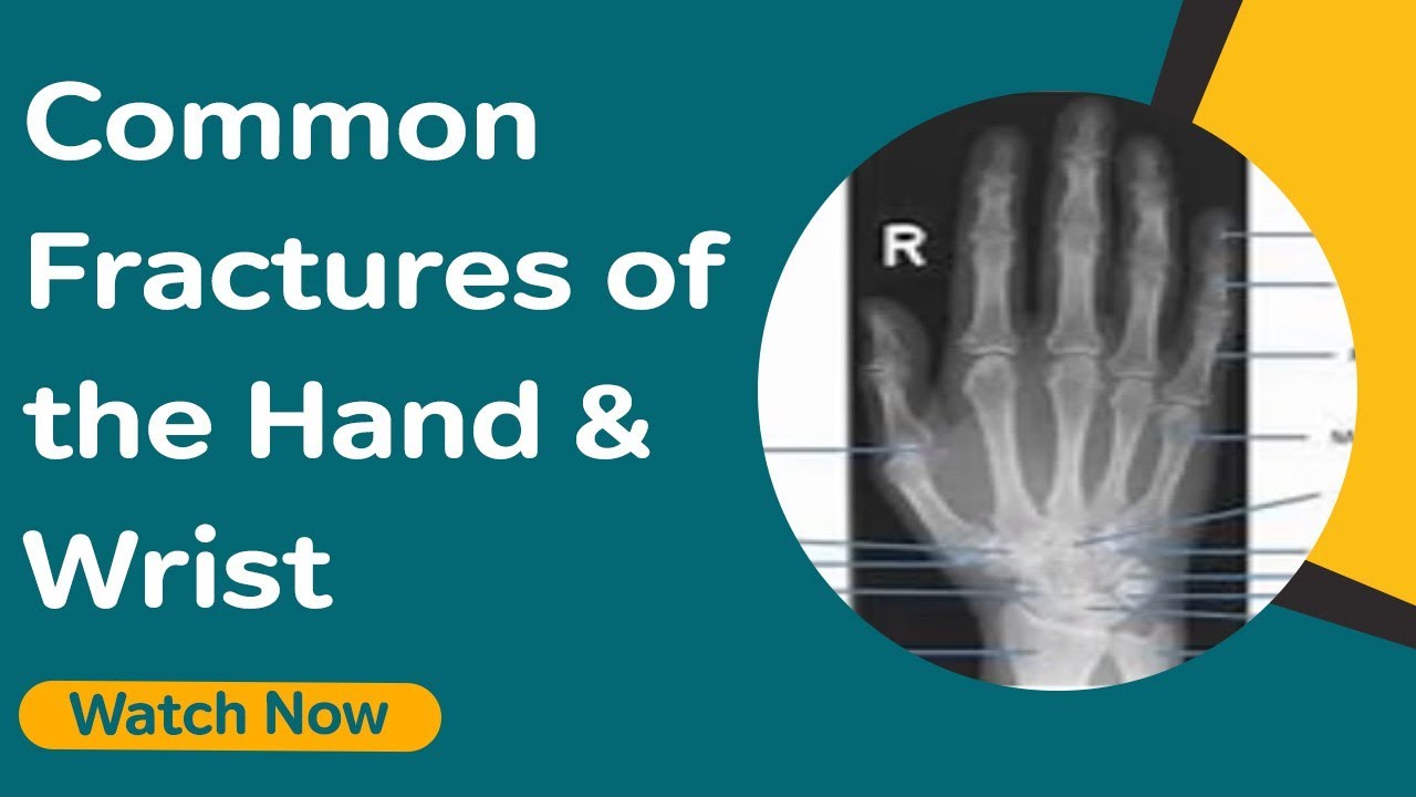 Common Fractures of the Hand & Wrist - YouTube