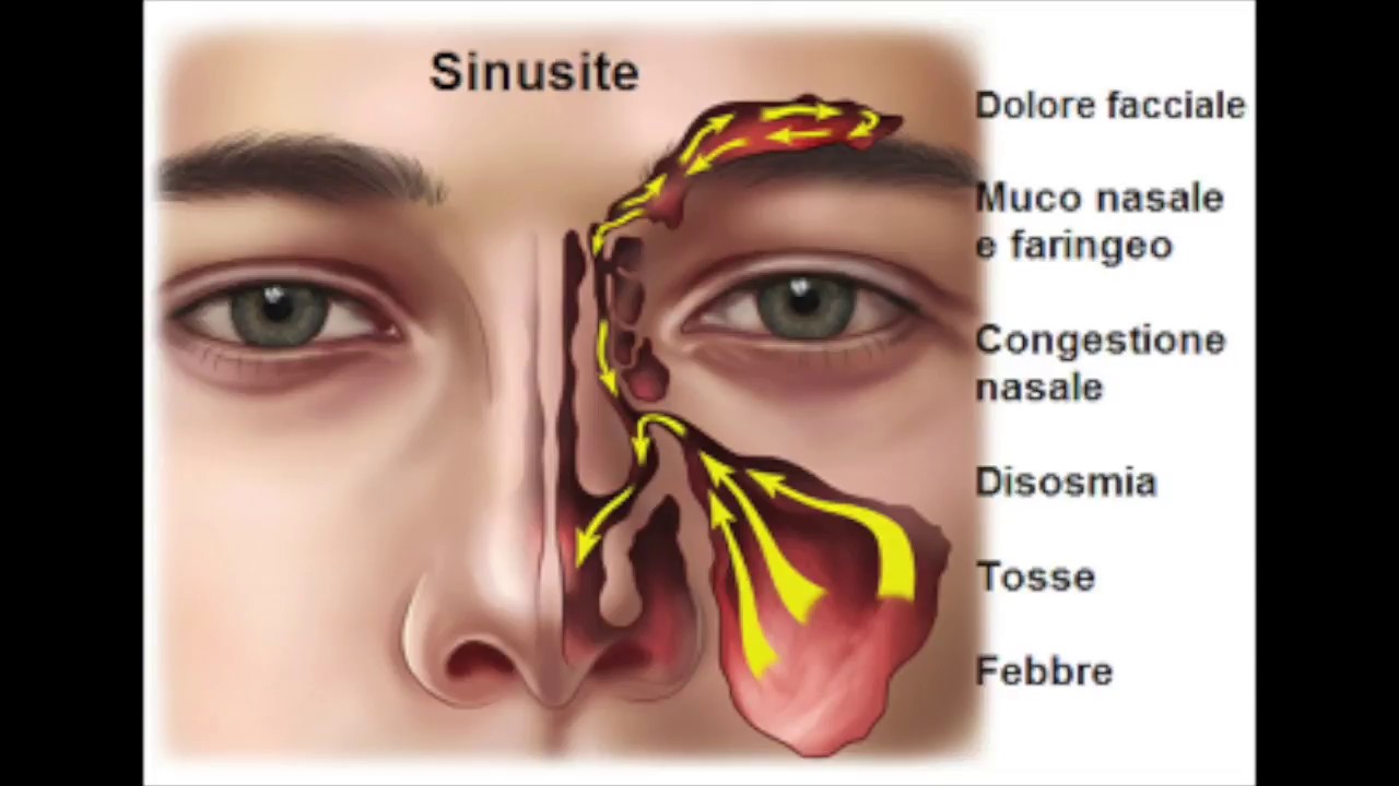 Dott. Carlo De Luca - La sinusite - YouTube