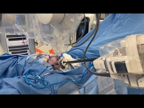 Single Port Robotic Right Hemicolectomy with Intracorporeal Anastomosis - YouTube