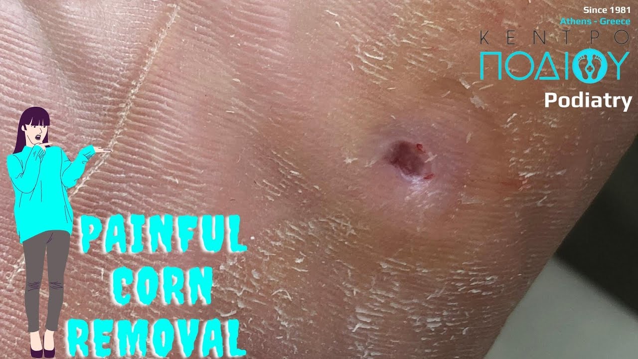 Painful corn removal|Αφαίρεση επίπονου τύλου|Κέντρο Ποδιού Podiatry ...