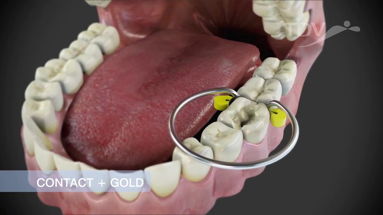 TDV Contact + Gold Restorative Instrument - YouTube