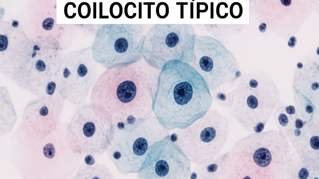 COILOCITO. Típica célula del VPH en microscopio electrónico papanicolao ...