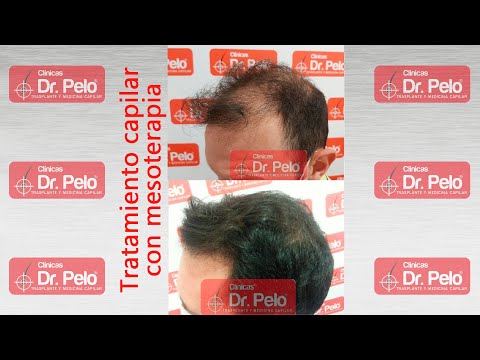 Tratamiento capilar con mesoterapia + Láser capilar LedHair + Tratamiento médico. Clínicas Dr. Pelo