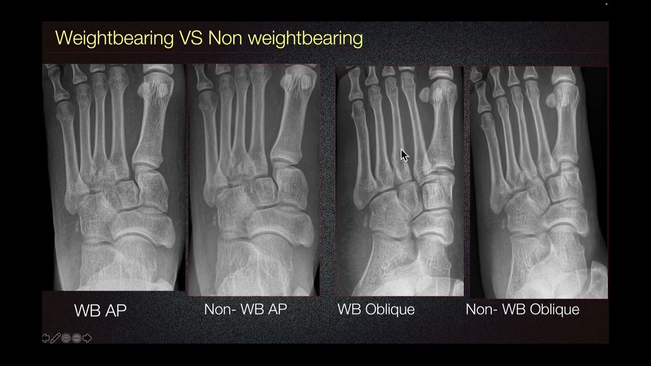 Sports Medicine Case 13 14 year old Foot Pain YouTube Sports Medicine Case 13 14 year old Foot Pain YouTube