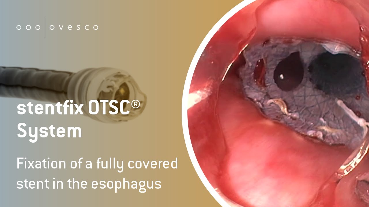 stentfix OTSC® System | Fixation of a fully covered stent in the ...