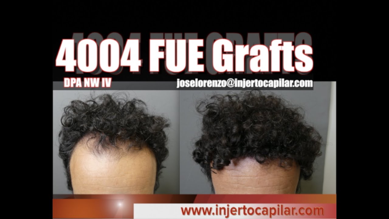 4004FUE Grafts. DPA NW IV. Curly hair. Temp peaks. Injertocapilar.com ...