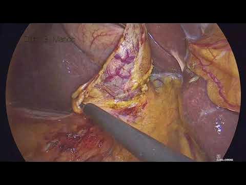 Laparoscopic Cholecystectomy - YouTube