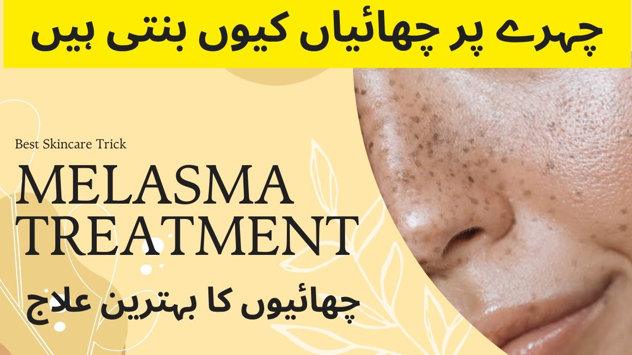 Melasma Treatment at Home | Melasma Cream and Melasma Home Remedies ...