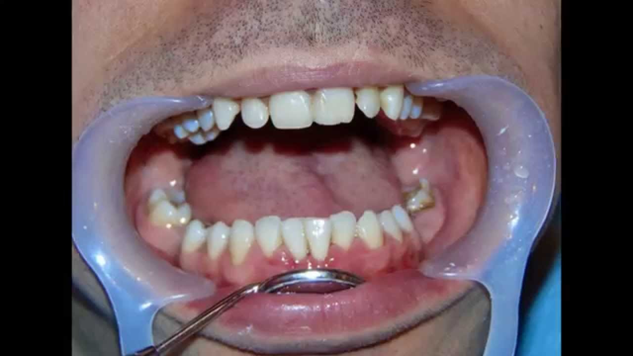 dentist-who: detartraj dentar prezentare 2015 - prezentare in imagini ...