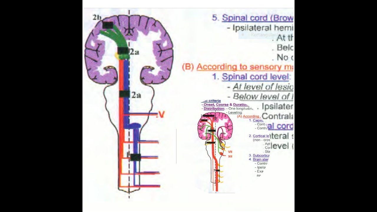 Hemiplegia (One side paralysis) - YouTube