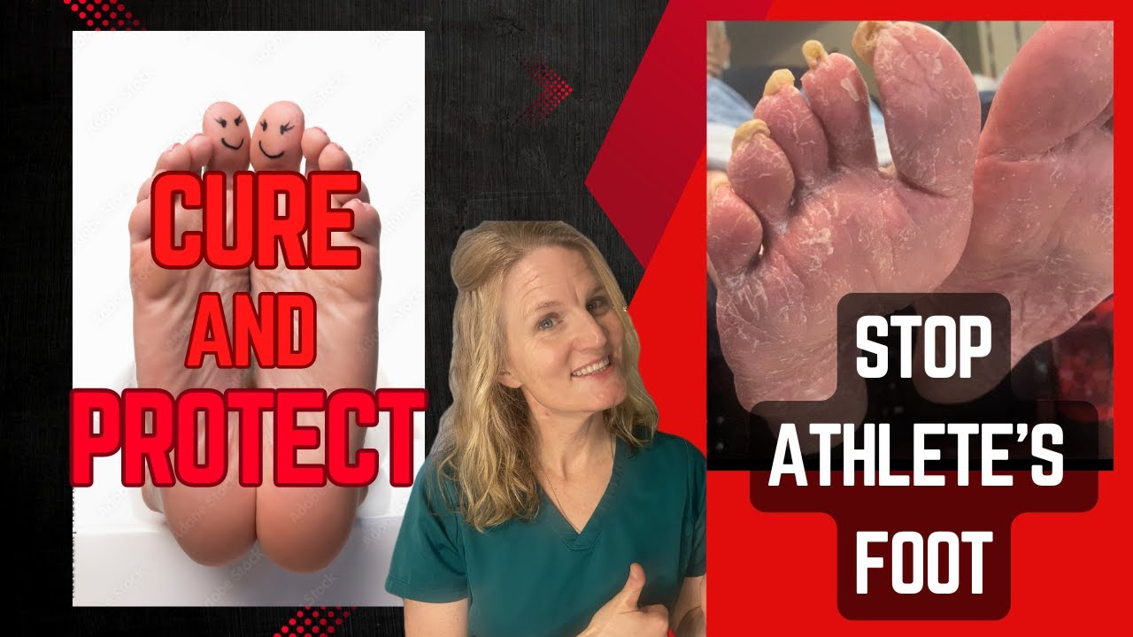 Stop Athlete's Foot: Podiatrist's 4 Proven Ways to Cure and Prevent it ...