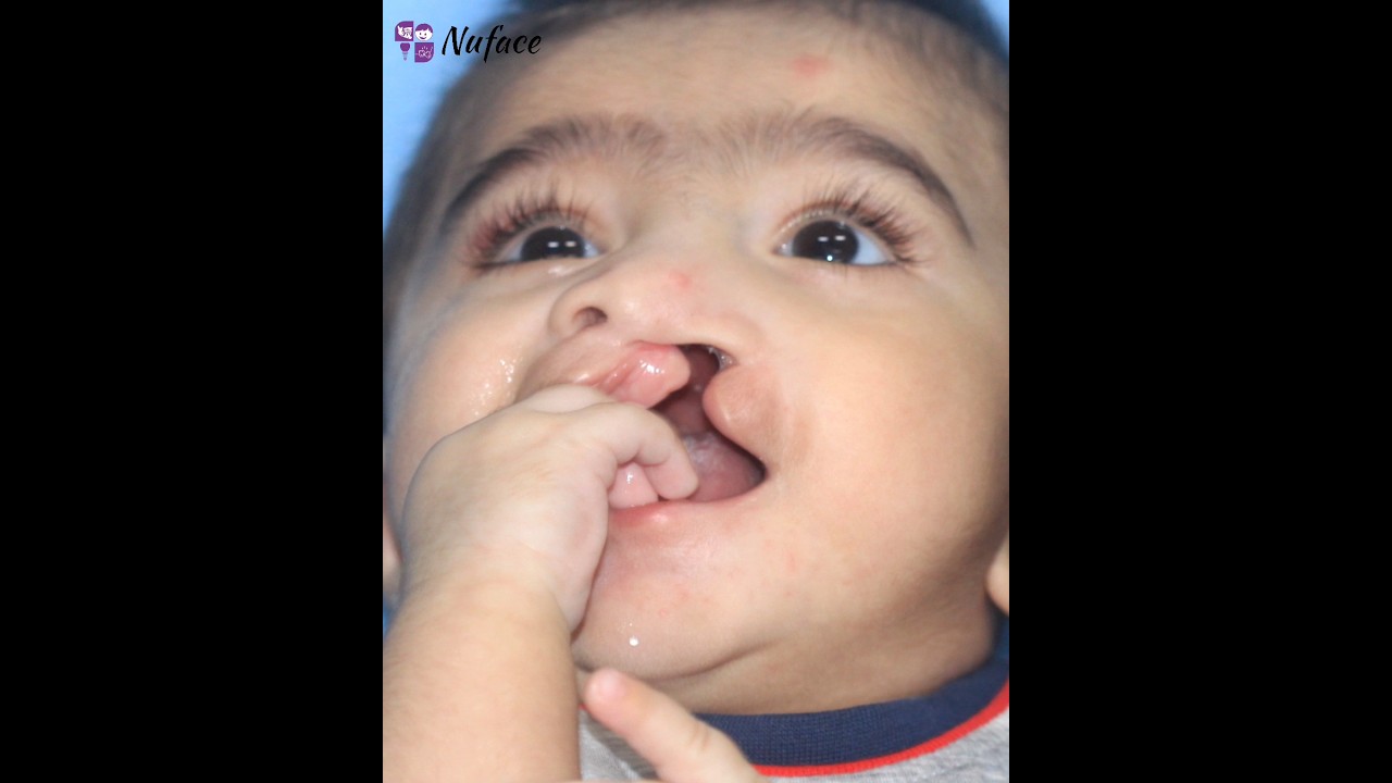 Types Of Cleft Lip Palate Procedure Cpt Code - Infoupdate.org Types Of Cleft Lip Palate Procedure Cpt Code - Infoupdate.org