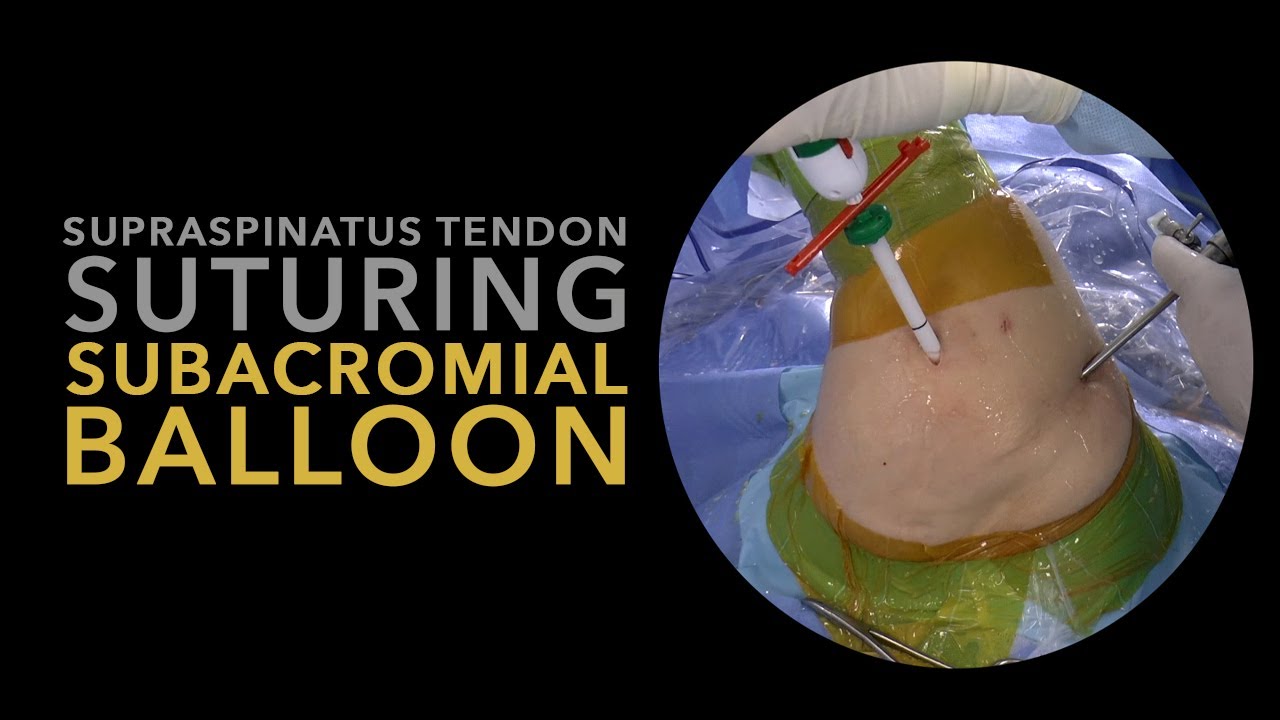Supraspinatus tendon suturing, biceps tendon tenodesis and subacromial ...