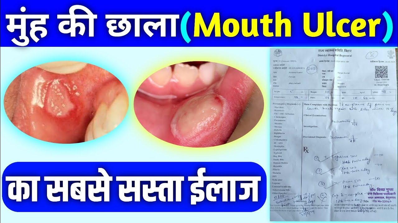 Chhala kaise theek karen | Munh ka Chhala kaise theek karen | Muh ke ...