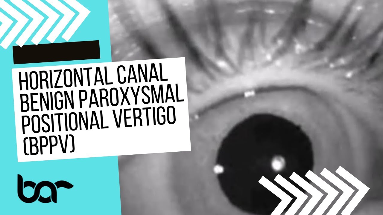 Eye Movements (Nystagmus) for Horizontal Canal BPPV (Talk Dizzy to Me ...