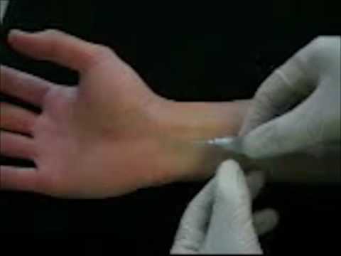 CTS injeksi steroid - YouTube