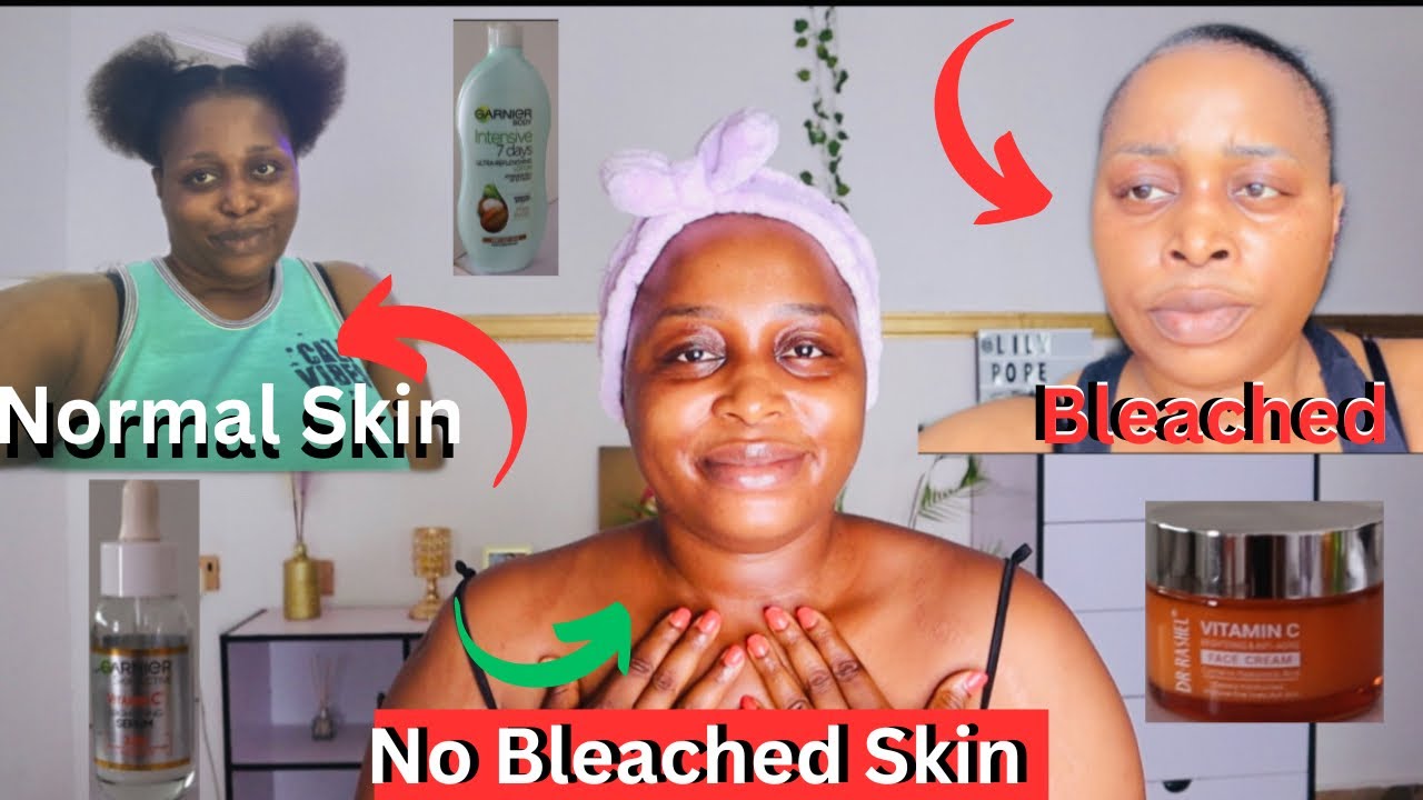 How I Stopped Bleaching With OUT Skin Damage || Transitioning TO No ...