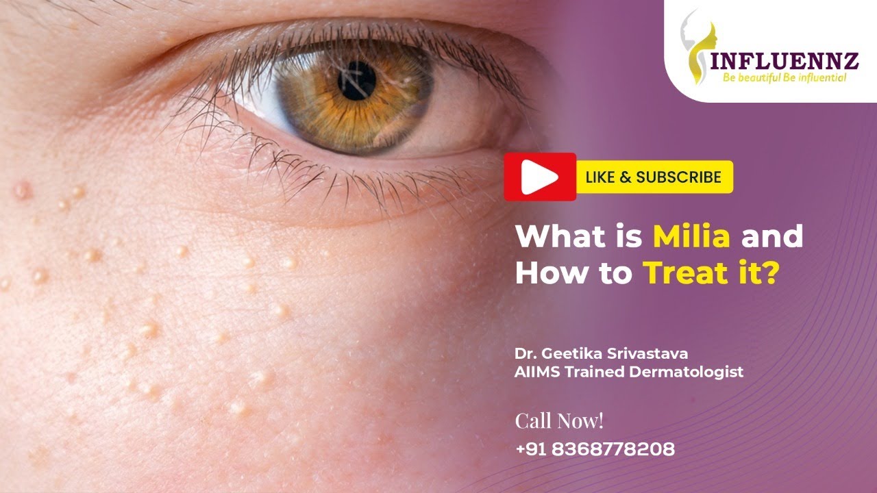 What is Milia & How is This Treated - Dr. Geetika Srivastava - YouTube