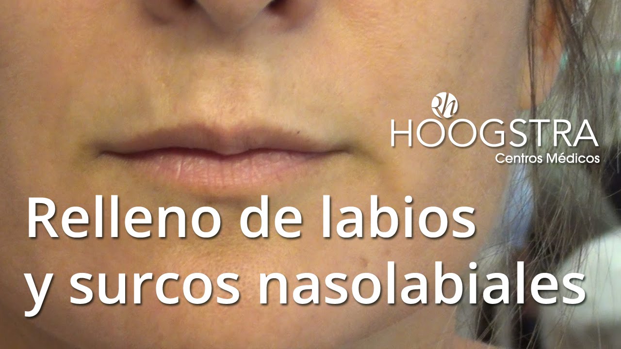 Relleno de labios y surcos nasolabiales (16010) - YouTube