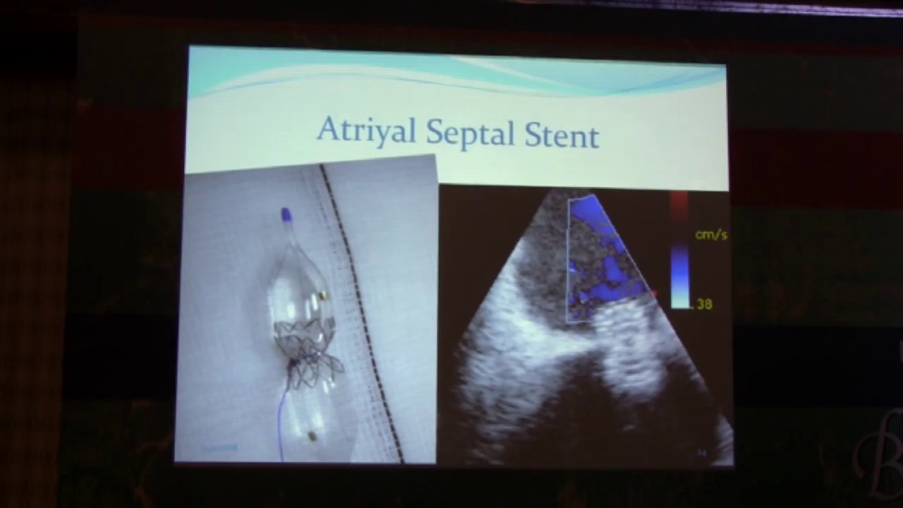 Pulmonary Hypertension, Intervention, Atrial Stent, Potts shunt ...
