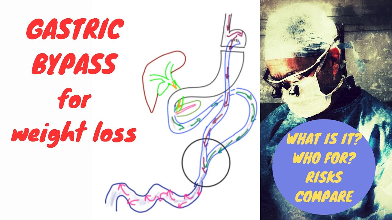 Gastric Bypass | Roux en Y Gastric Bypass | RYGB - YouTube