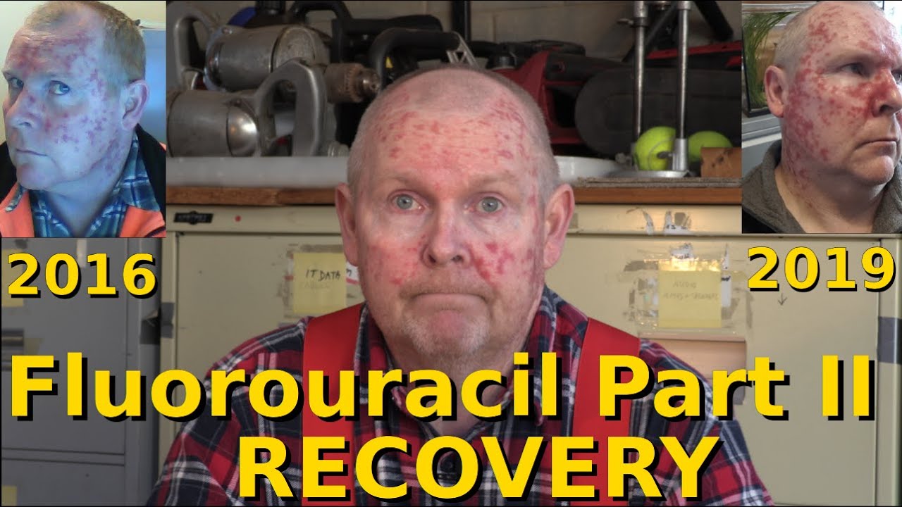 Flourouracil (Efudex) skin cancer treatment Part 2 - Recovery - YouTube