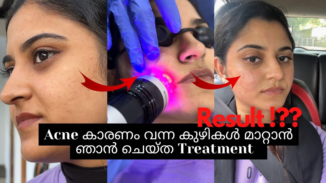 MNRF Treatment ചെയ്തു- എന്റെ Experience ഇതാണ് | "My Result After 3 ...
