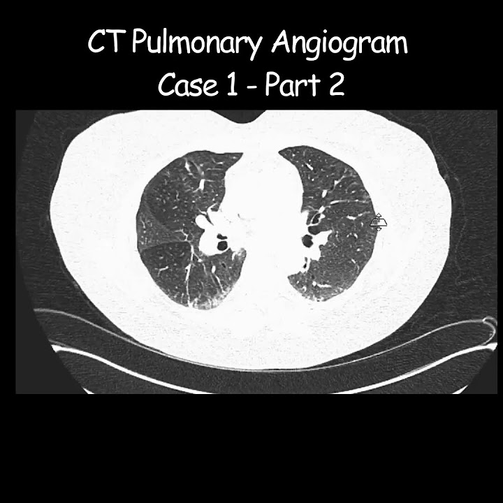 Ct Pulmonary Angiogram Case 1 Part 2 Radiologist Radiology