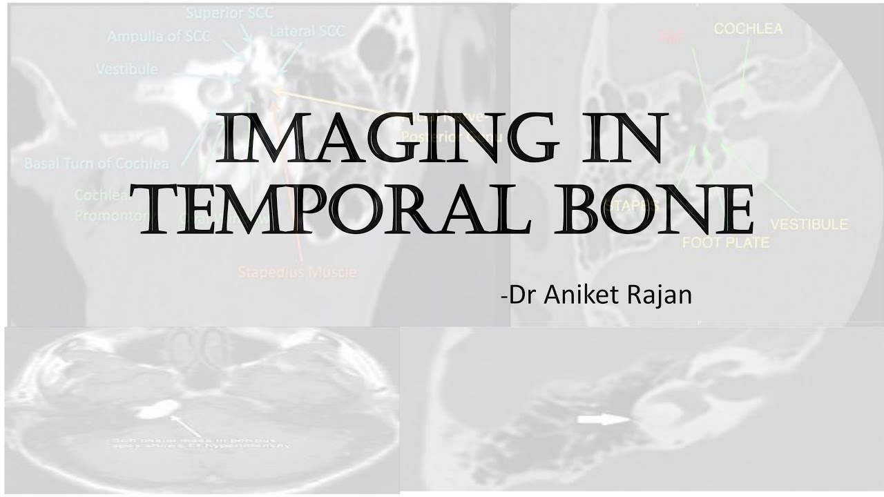 IMAGING OF TEMPORAL BONE - YouTube