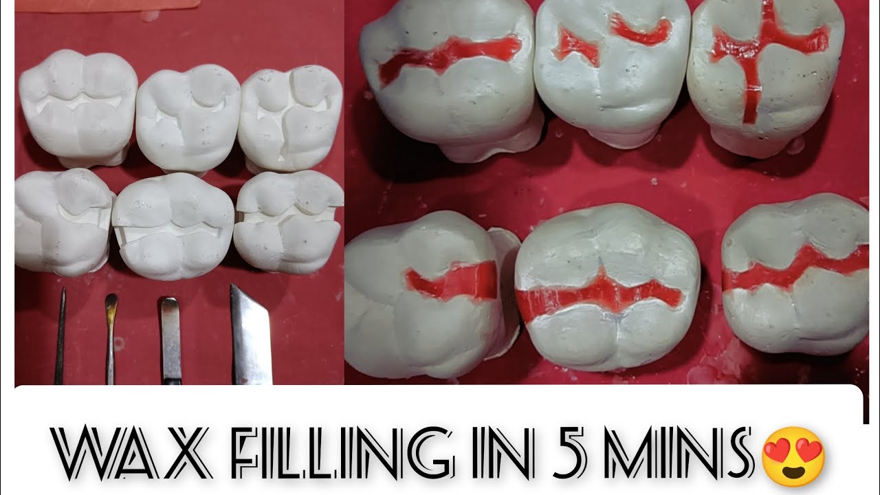 Wax Filling Of Plaster Models in 5 Mins😍 Explained In Detail! # ...
