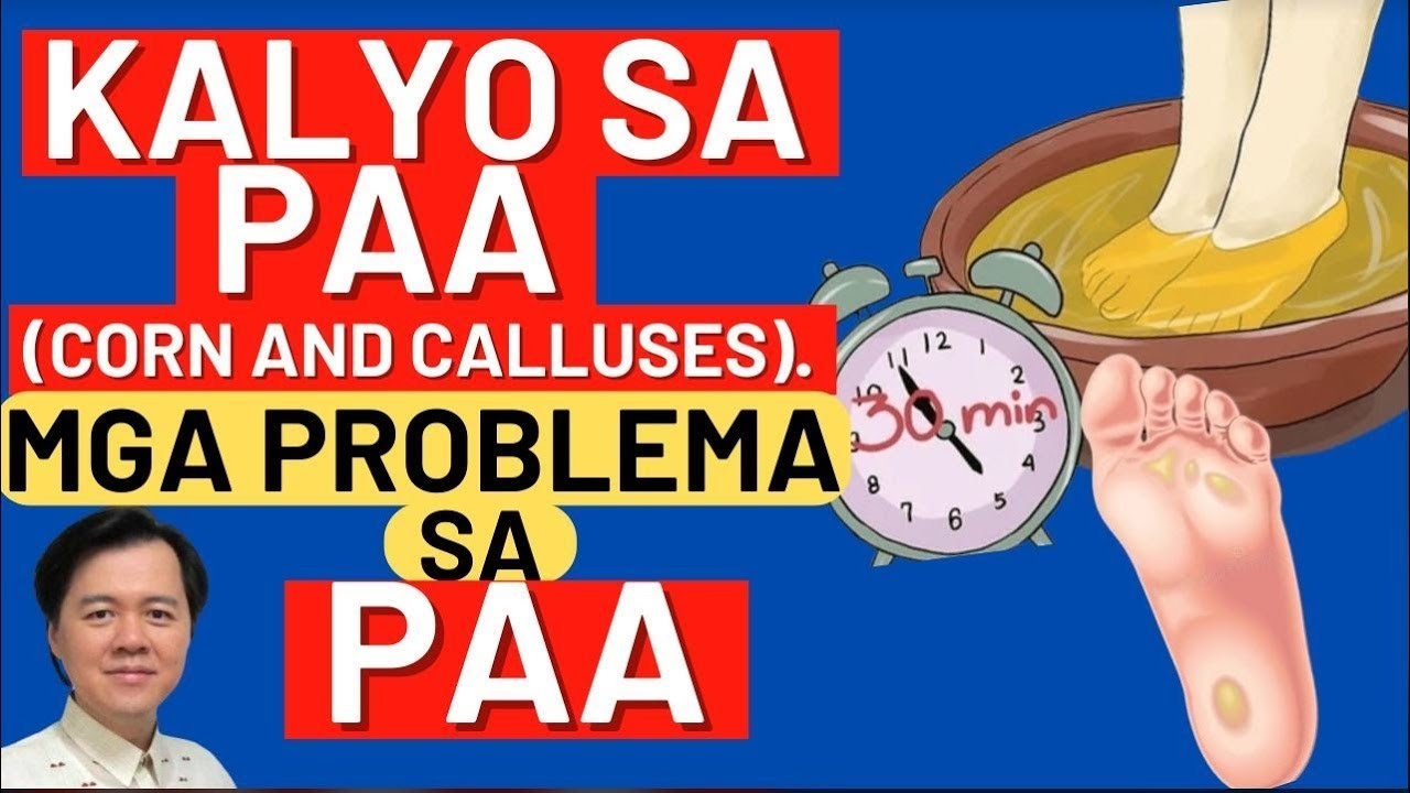 Mga Problema sa Paa: Kalyo sa Paa (Corn and Calluses) - YouTube