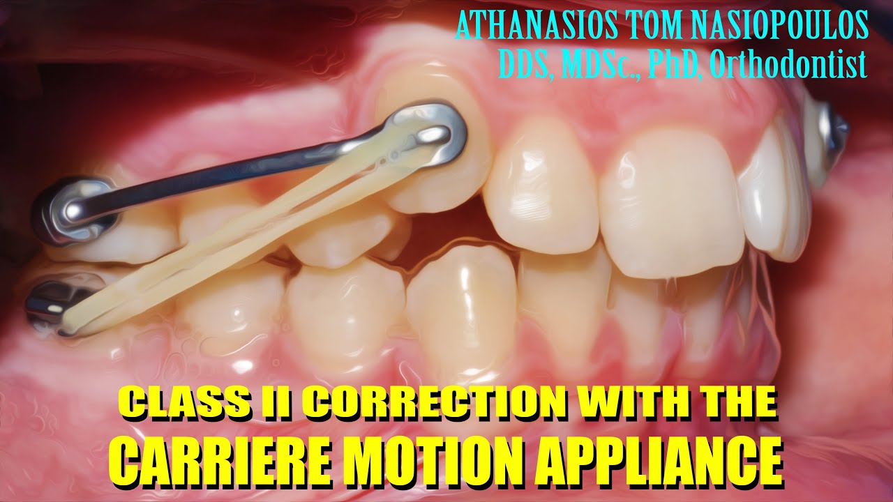Class II correction with Carriere | Athanasios Tom Nasiopoulos - YouTube