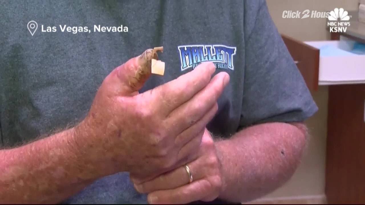 Cowboy's thumb reattached after roping mishap - YouTube