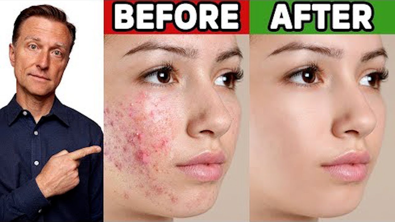 The Best Trick for Clear Skin (Acne, Aging, Wrinkles, Liver Spots) | Dr ...