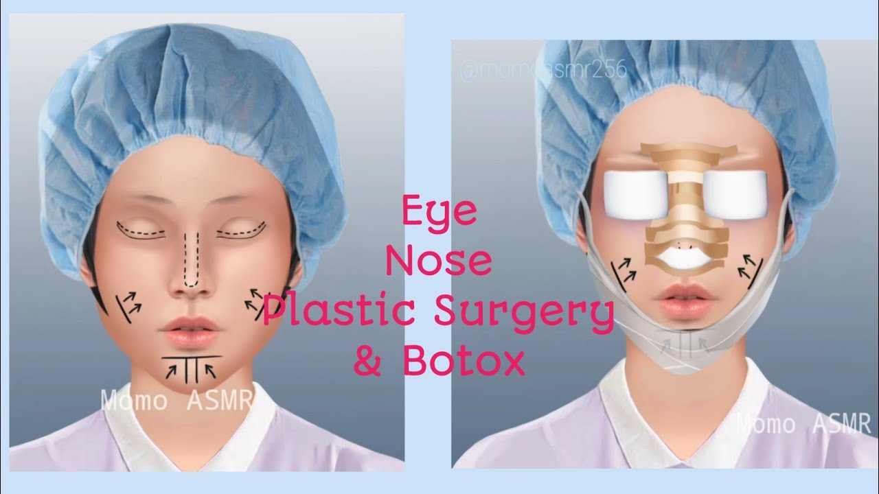ASMR Eyelid Nose plastic surgery animation #treatmentanimation # ...