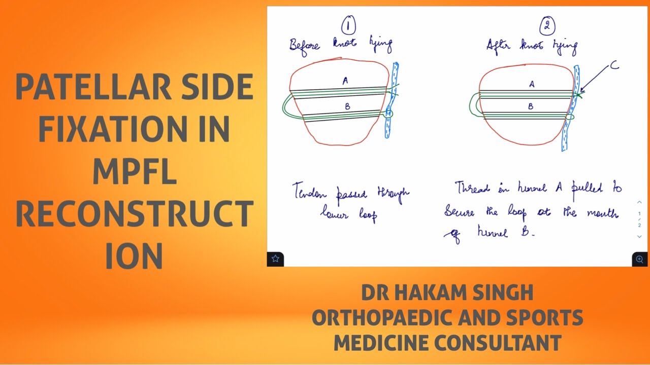 Patellar side fixation in MPFL reconstruction - YouTube