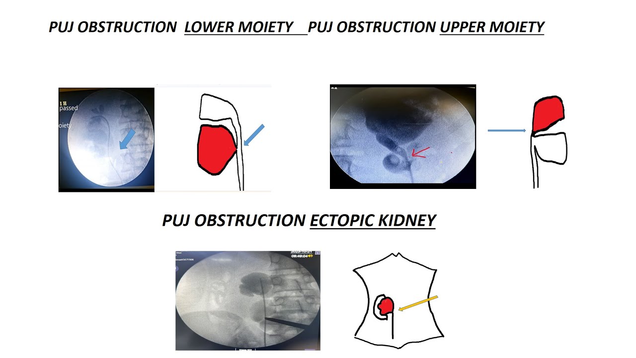 Laparoscopic upper urinary tract reconstruction in anomalous kidneys ...