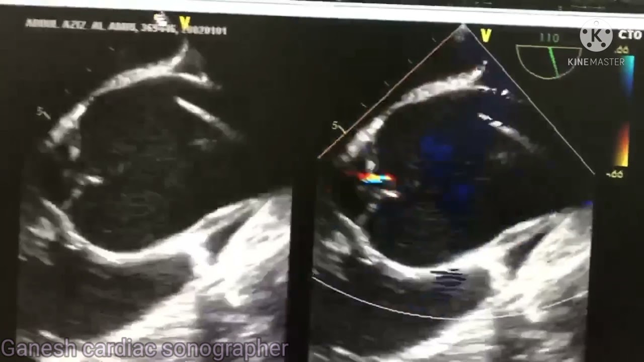 //Aortic valve abscess// Ganesh cardiac sonographer - YouTube